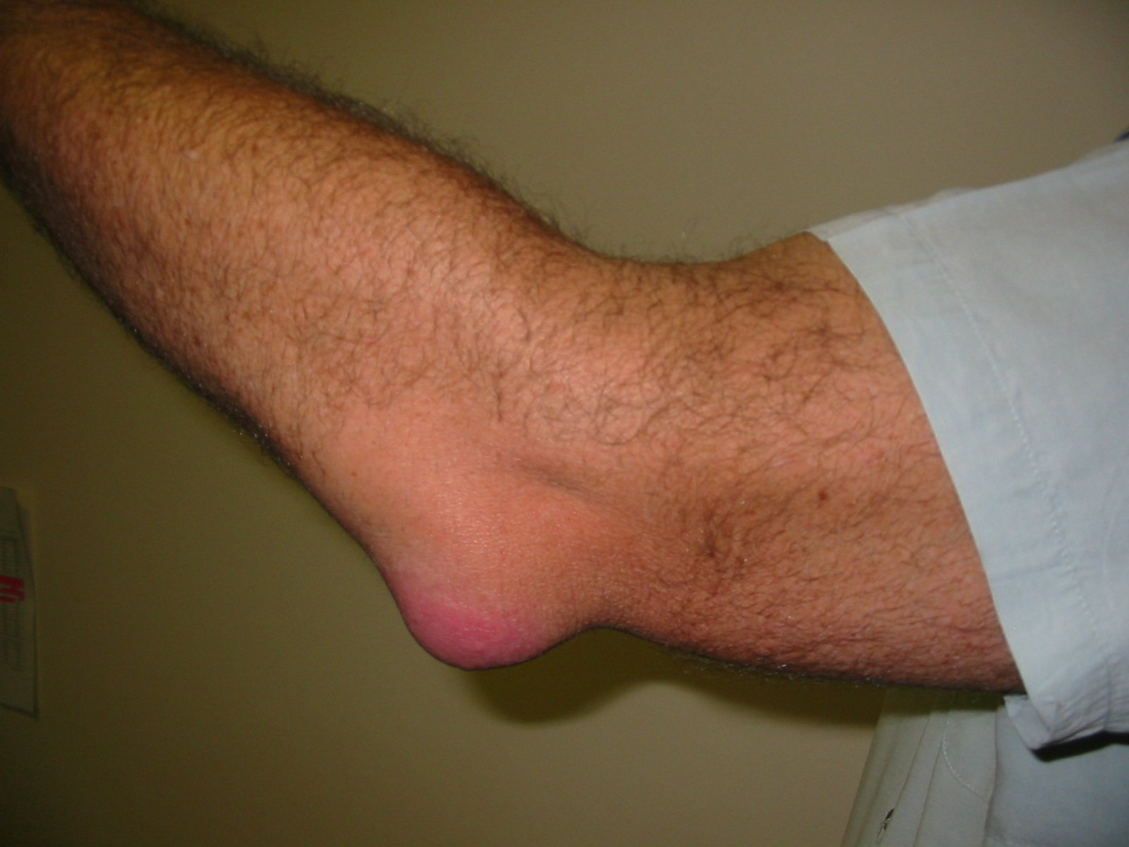 Bursitis types - Glrya Orthopedics