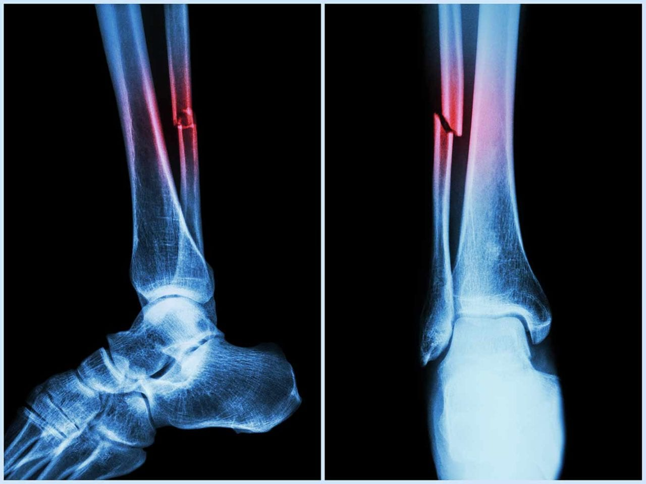 Causes of Bone Fracture - Glrya Orthopedics
